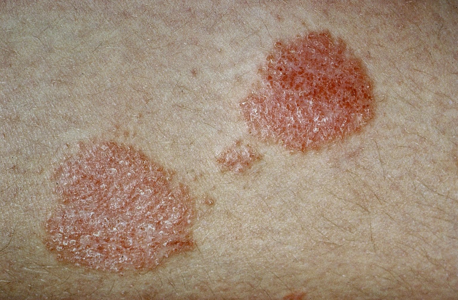 Nieuw! Column dermatologie: Een rood schilferende huid, van buiten naar ...