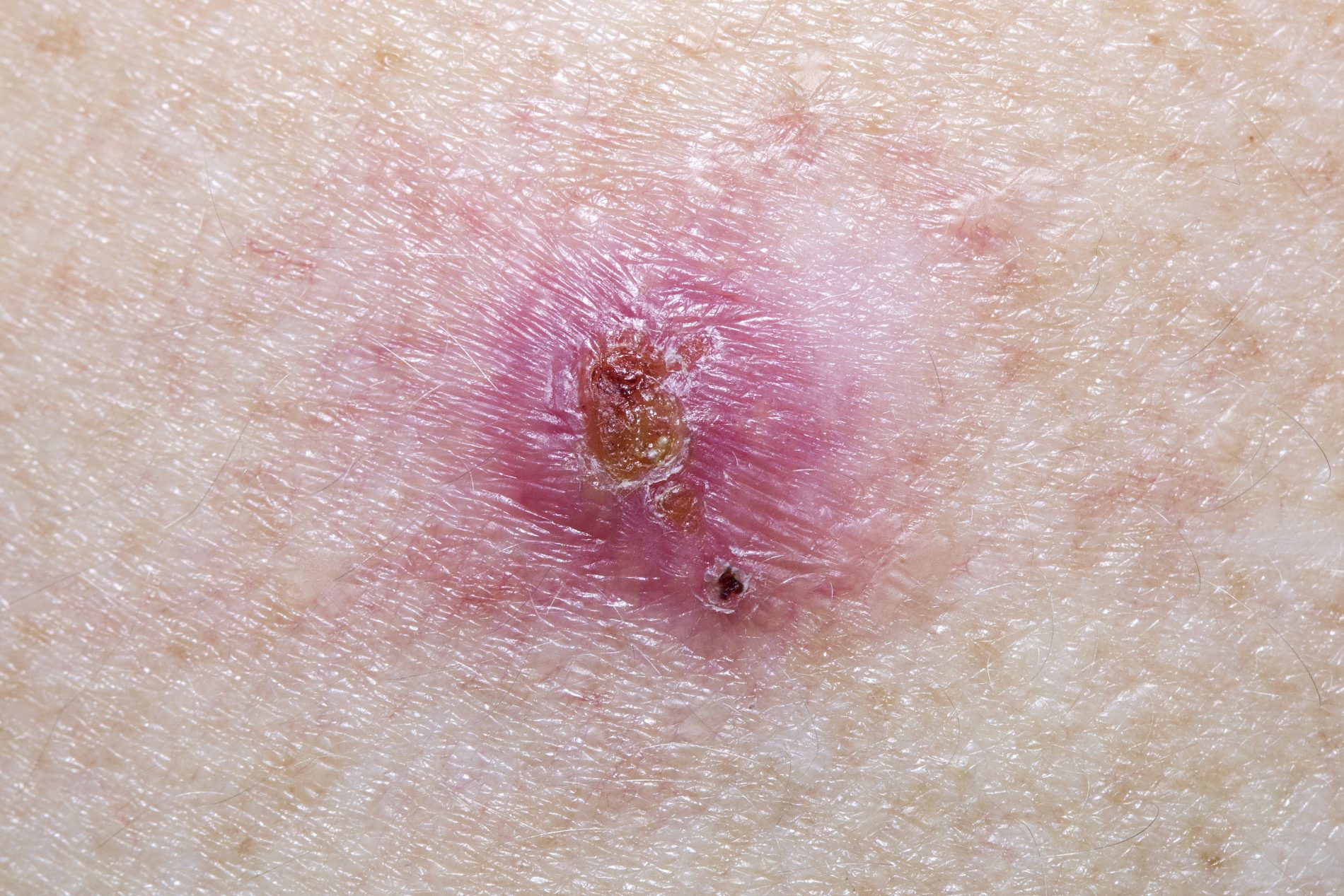 Dermatologie: Vlekjes en plekjes... Huidkanker? - Beauty-Pro.nl